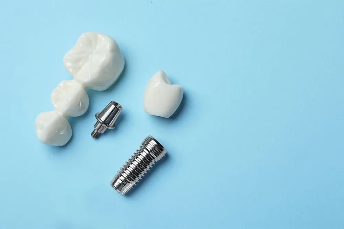 Various Types of Dental Implants