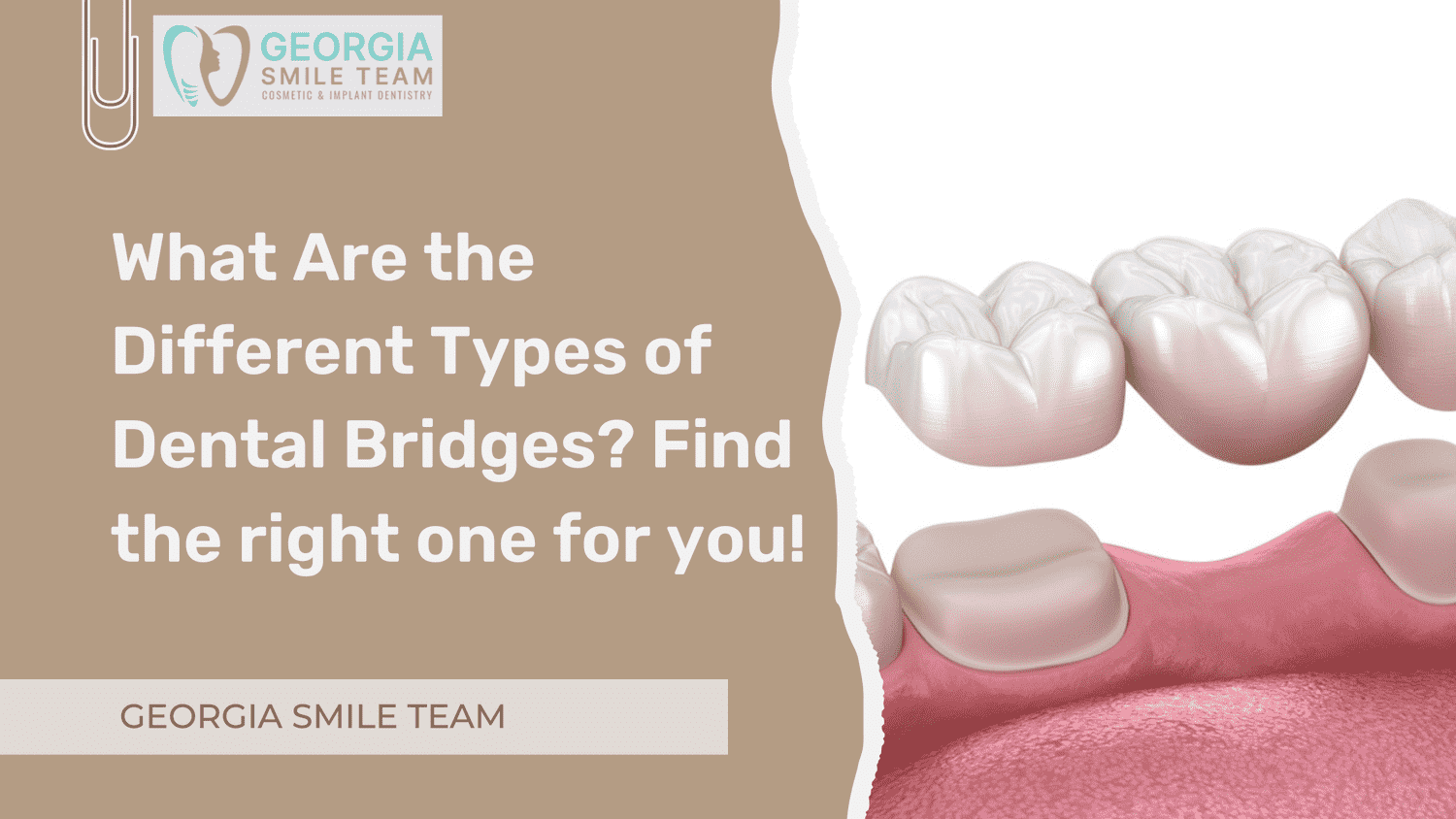 Restore Your Smile with Dental Bridges in Gainesville